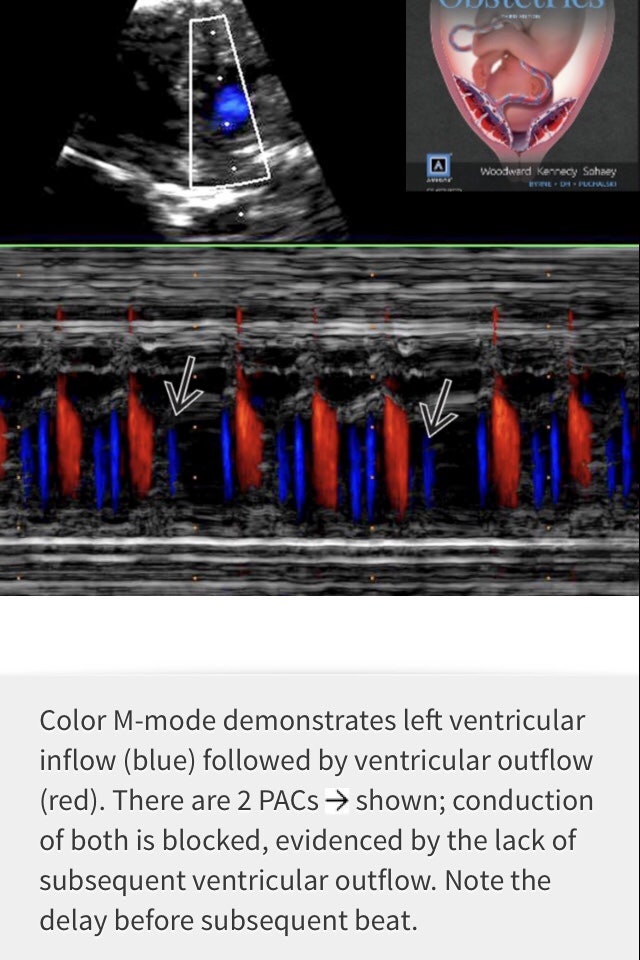 chap 33 정리] Fetal arrhythmias : 네이버 블로그