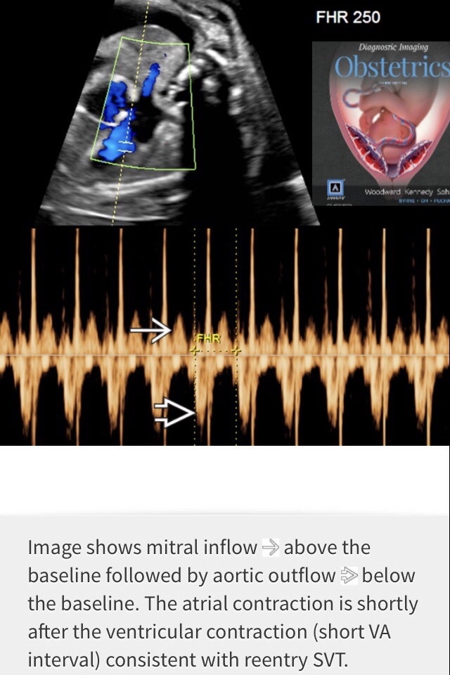 chap 33 정리] Fetal arrhythmias : 네이버 블로그