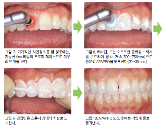 의료용 나노 하이드록시아파타이트(nano medical hydroxyapatite) 이용한 치아재광화촉진제, 아파프로 ...