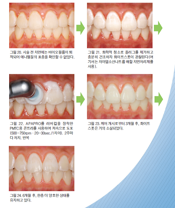 의료용 나노 하이드록시아파타이트(nano medical hydroxyapatite) 이용한 치아재광화촉진제, 아파프로 ...