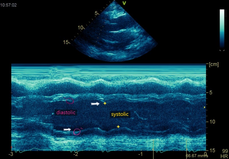 Dyssynchronous septal wall motion(LBBB) : 네이버 블로그