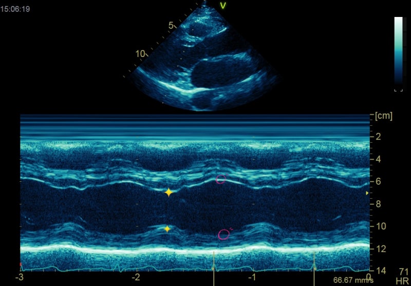 Dyssynchronous septal wall motion(LBBB) : 네이버 블로그