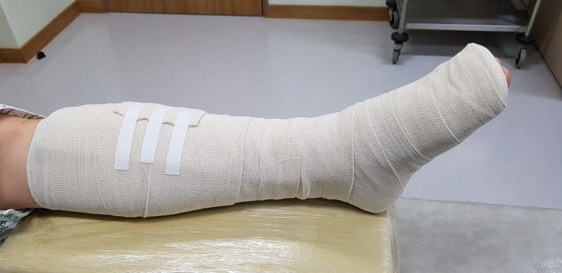 Short Leg Dorsal Splint Type : 네이버 블로그