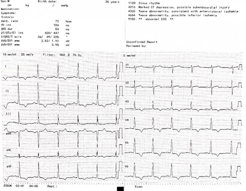EKG of Hypertrophic Cardiomyopathy? : 네이버 블로그