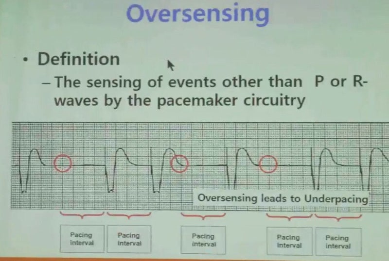 Pacemaker / ICD : 네이버 블로그