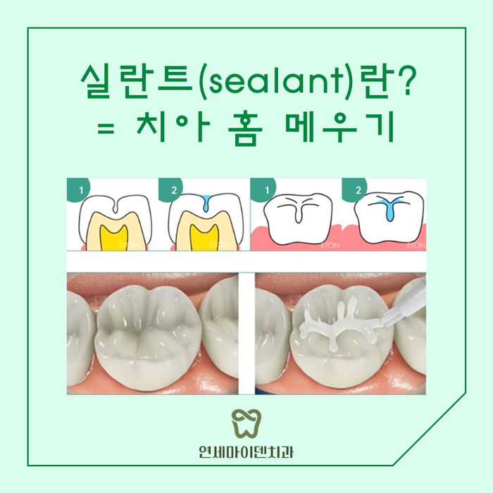 치아 홈 메우기 실란트sealant로 우리 아이 충치 예방 실란트 치면열구전색 치아홈메우기 네이버 블로그