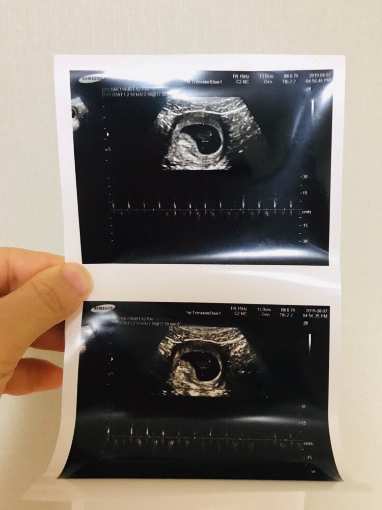 7주6일초음파사진8주 초음파사진아기 심장소리듣기 네이버 블로그
