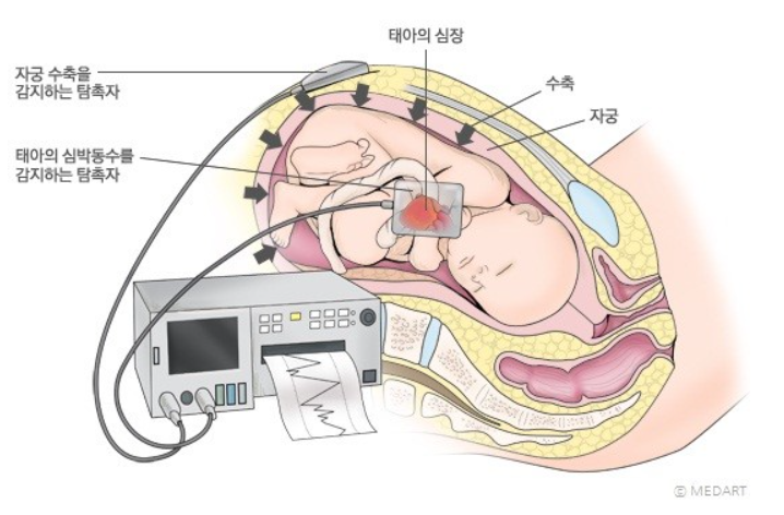 임산부 막달 검사 태동 검사 Nst 네이버 블로그