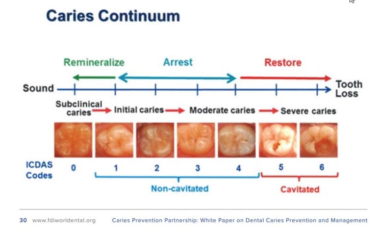 ICDAS 국제 충치 분류 기준 치대생/ 일반 덕후 : 네이버 블로그