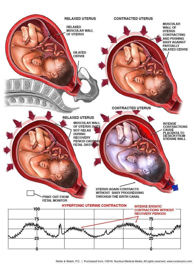 [NCLEX-OB] Labor&Delivery : 네이버 블로그