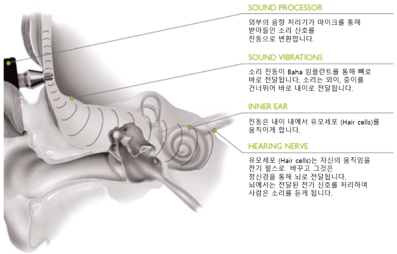 [세종시 보청기] 이식형 골전도 보청기 BAHA (1) : 네이버 블로그