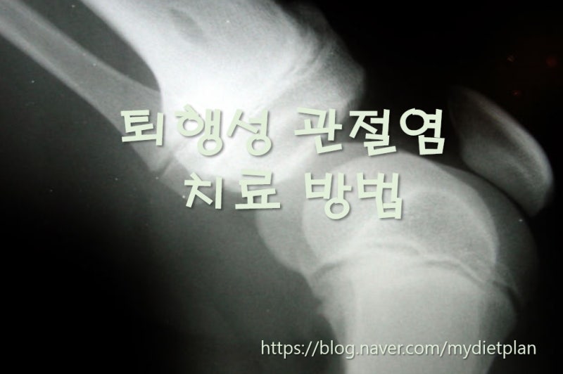 무릎 퇴행성 관절염 증상과 퇴행성 관절염 치료 방법 네이버 블로그