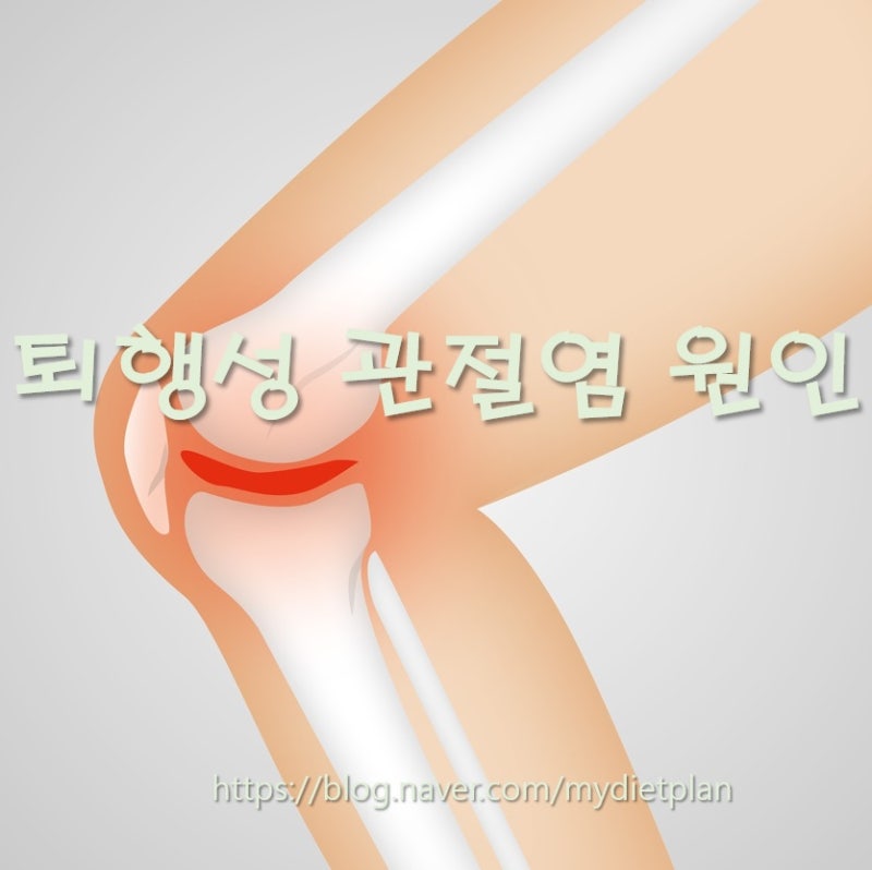 퇴행성 무릎 관절염 증상과 퇴행성 관절염 운동 네이버 블로그