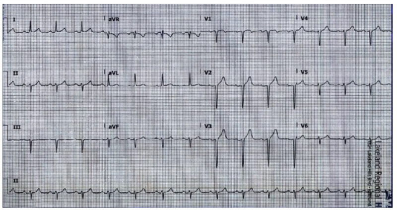 ECG, new tall T wave in V1(NTTV1) : 네이버 블로그