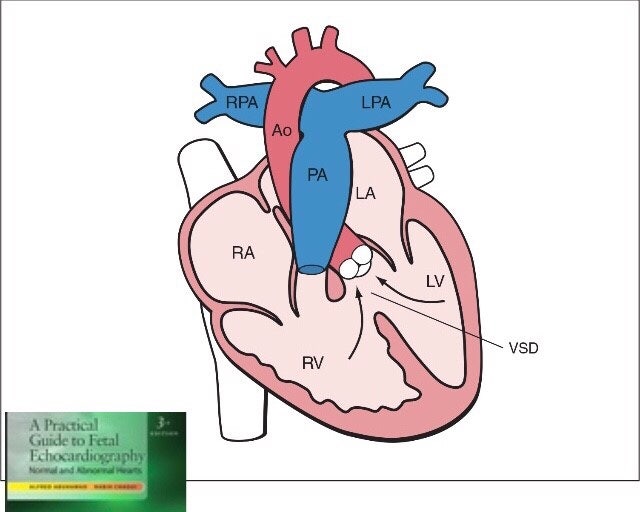 Chap 25. TOF ,PA with VSD, Absent PV SD 요약 정리 : 네이버 블로그