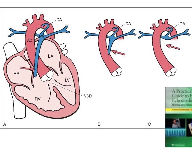 Chap 25. TOF ,PA with VSD, Absent PV SD 요약 정리 : 네이버 블로그