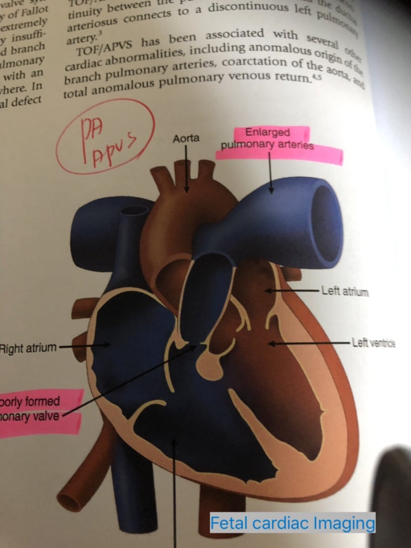 Chap 25. TOF ,PA with VSD, Absent PV SD 요약 정리 : 네이버 블로그