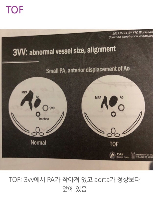 Chap 25. TOF ,PA with VSD, Absent PV SD 요약 정리 : 네이버 블로그