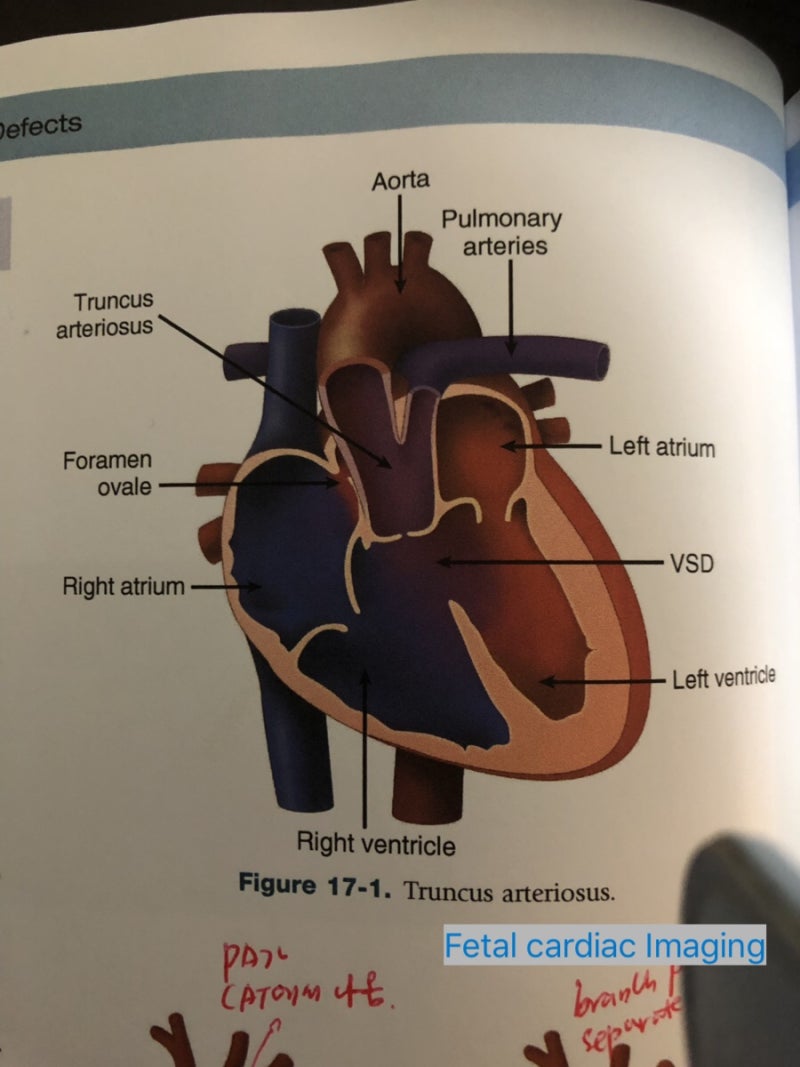 Chap 25. TOF ,PA with VSD, Absent PV SD 요약 정리 : 네이버 블로그