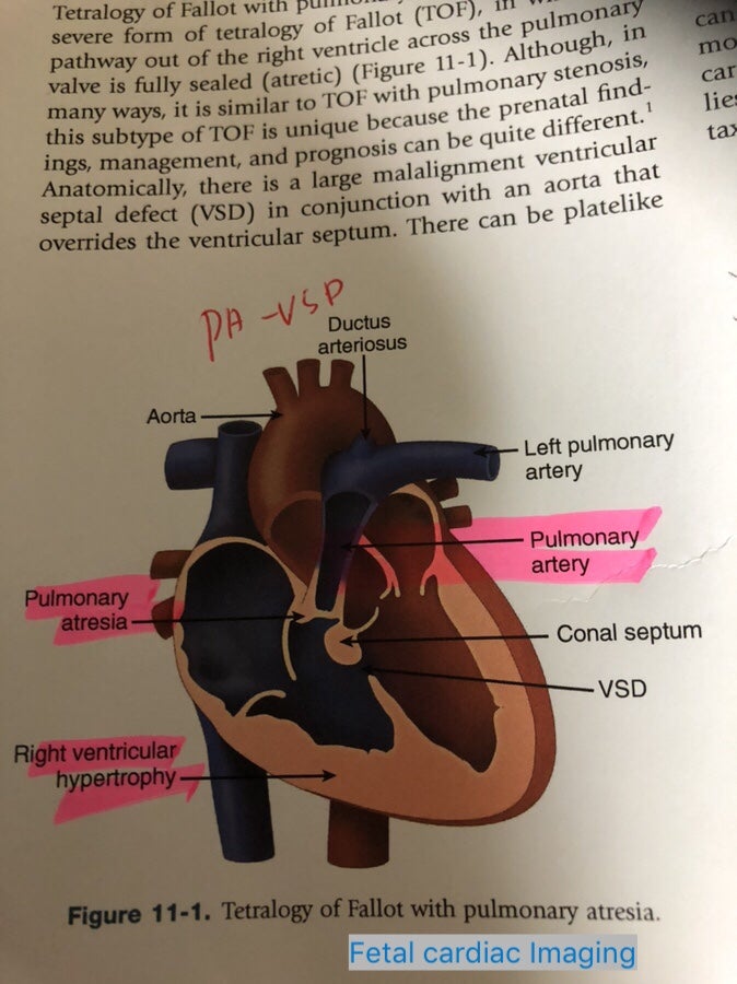 Chap 25. TOF ,PA with VSD, Absent PV SD 요약 정리 : 네이버 블로그