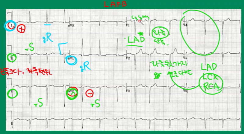 Left anterior fascicular block/hemiblock(좌각앞속차단, 좌각전지블록) 심전(ECG) 원리 ...
