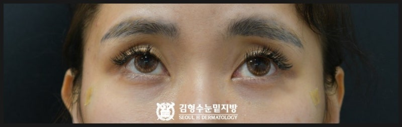 눈꺼풀이 심하게 꺼진 젊은 여성분의 눈꺼짐 필러 주입술 눈꺼풀필러 눈꺼짐필러 네이버 블로그