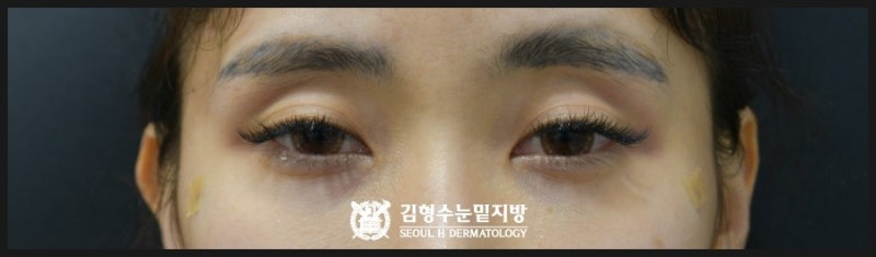 눈꺼풀이 심하게 꺼진 젊은 여성분의 눈꺼짐 필러 주입술 눈꺼풀필러 눈꺼짐필러 네이버 블로그
