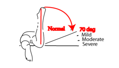 Femoral torsion(Anteversion) : 네이버 블로그