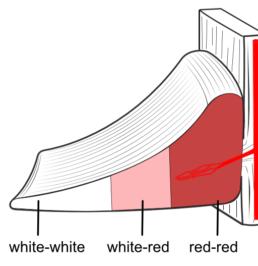 [구파발/연신내 재활운동] 반월상 연골 손상(Meniscal injuries) : 네이버 블로그