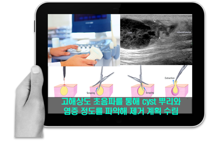 피지낭종 제거수술 봉합방식이 안전과 흉터문제를 좌우한다 네이버 블로그
