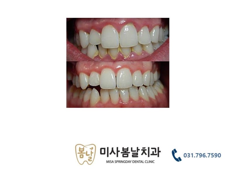 치아 흔들림 가장 흔한 원인은 네이버 블로그