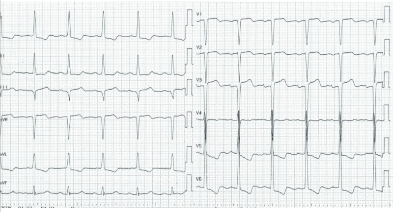 대동맥 판막 협착증, 심전도, Aortic stenosis, electrocardiogram : 네이버 블로그