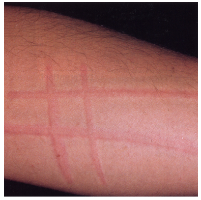피부묘기증, Dermographism(dermatographism, urticaria factitia, dermographic ...