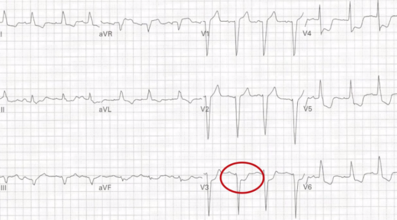 LBBB에서 AMI 진단, ECG : 네이버 블로그