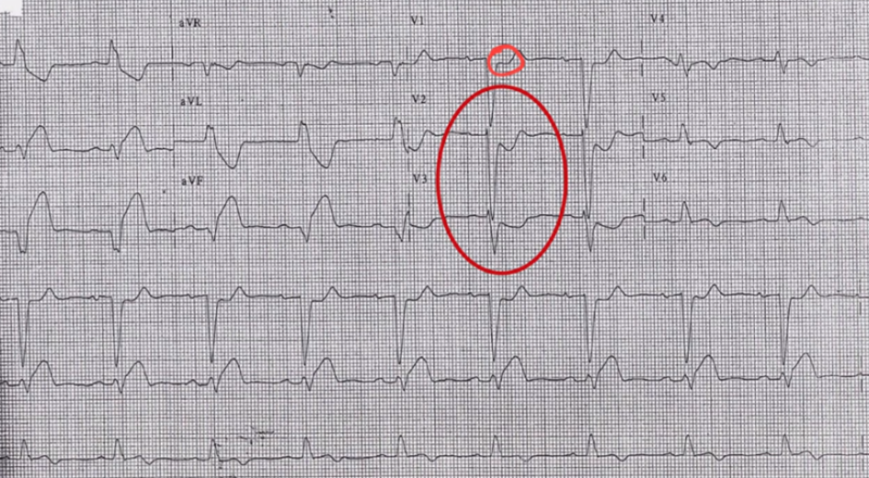 LBBB에서 AMI 진단, ECG : 네이버 블로그