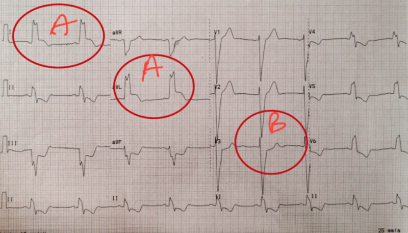 LBBB에서 AMI 진단, ECG : 네이버 블로그