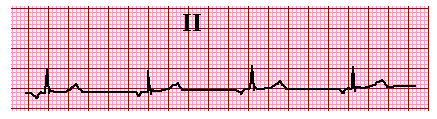 Ectopic atrial rhythm : 네이버 블로그