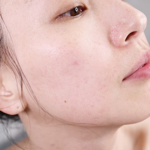 티트리오일 효능 유기농 100로 콕 찍어 바르면 쏙 들어가는 효과 네이버 블로그
