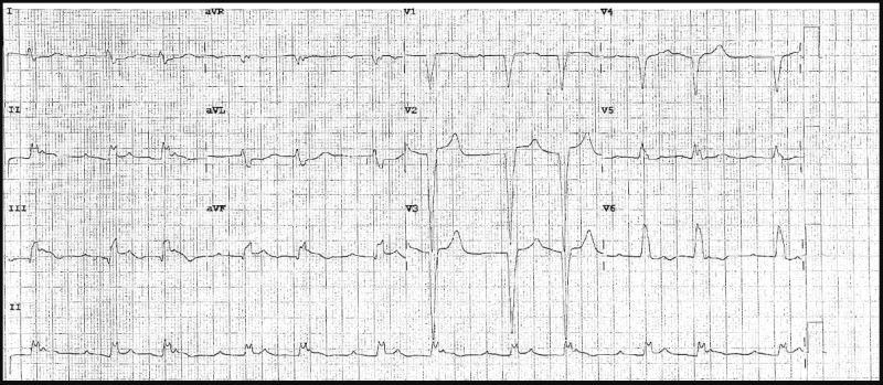 LBBB에서 AMI 진단, ECG : 네이버 블로그