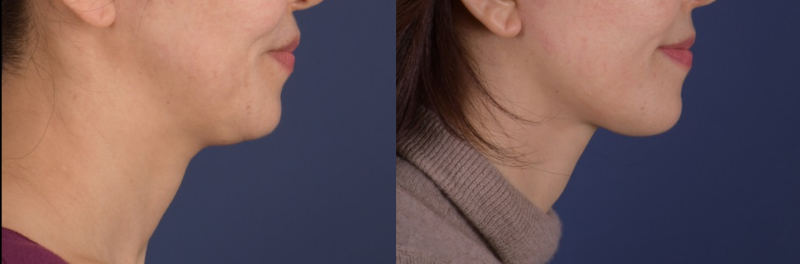 안면윤곽술과 안면거상술_Facial Bone Contouring Surgery and Face lift : 네이버 블로그