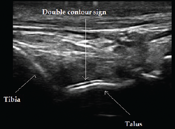 통풍 : 네이버 블로그