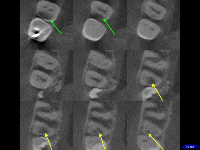 닥터자일리톨의 치과사전 :: CBCT ( Cone Beam CT ; 콘빔씨티 )란 무엇인가 ? :: 치과에서 진단을 위해 ...