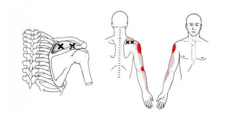 극상근supraspinatus 가시위근 해부학 회전근개 운동 스트레칭 어깨 회전근개파열 어깨충돌증후군 네이버 블로그