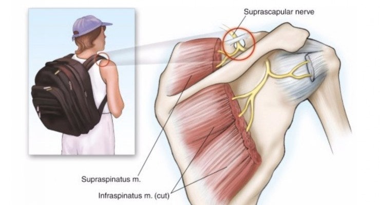극상근supraspinatus 가시위근 해부학 회전근개 운동 스트레칭 어깨 회전근개파열 어깨충돌증후군 네이버 블로그