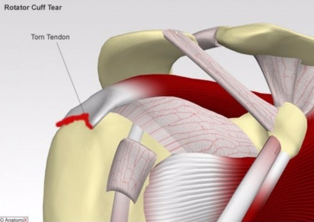 극상근supraspinatus 가시위근 해부학 회전근개 운동 스트레칭 어깨 회전근개파열 어깨충돌증후군 네이버 블로그