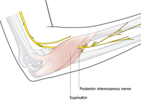 요골신경포착증후군, 회외근 증후군(Supinator syndrome) : 네이버 블로그