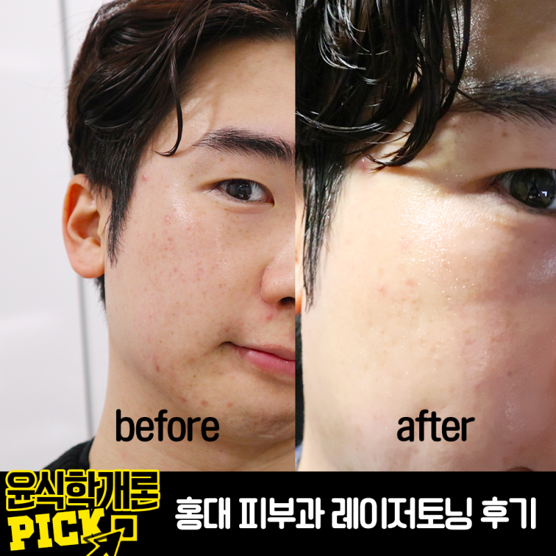 홍대 피부과에서 레이저토닝으로 얼굴잡티제거 효과 후기 네이버 블로그