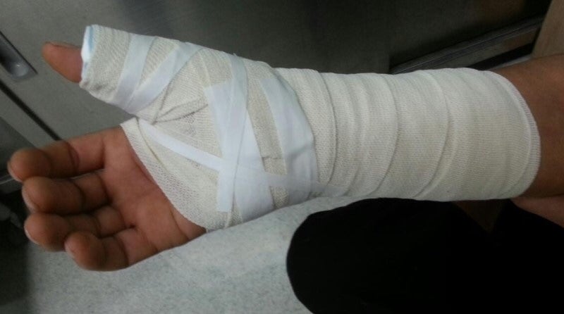 Short Arm Thumb Spica Splint : 네이버 블로그