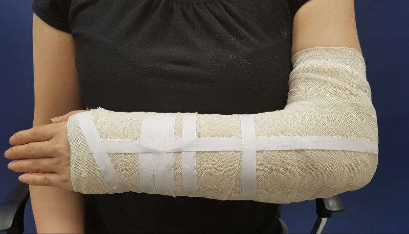 Sugar Tong Splint : 네이버 블로그