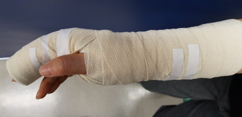 Short Arm Radial Gutter Splint : 네이버 블로그
